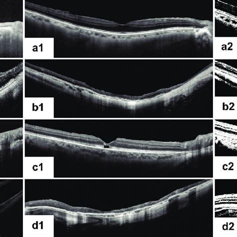 Surgical Cases A Pre Operative Oct Findings Were Consistent With