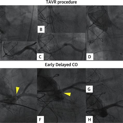 Ct Measurements Before Tavr Download Table