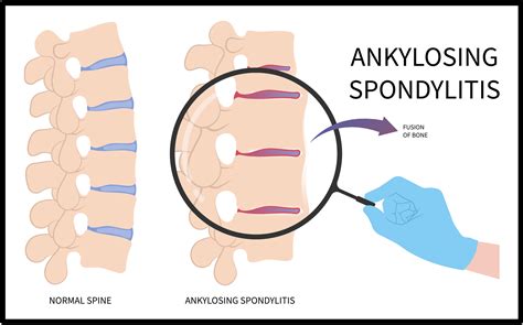 Bamboo Spine Ankylosing Spondylitis Spine Spine Education
