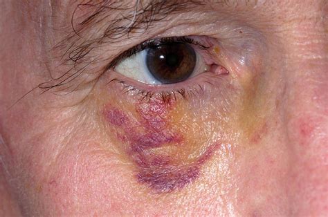 Post Op Bruising Of The Eyelid Photograph By Dr P Marazzi Science