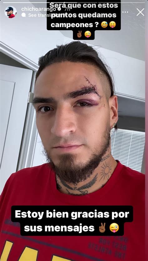 [chicho] Received Stitches After The Match On Saturday R Mls