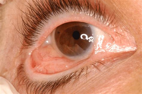Symblepharon Of The Lateral Portion Of The Conjunctival Fornix In