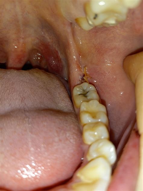 Extraction Sites Look A Bit Angry Do U Think It Looks Like Infection Rdentalhygiene