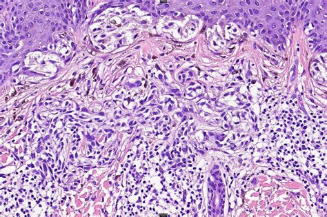 Nevus Of Scalp Mckee Derm