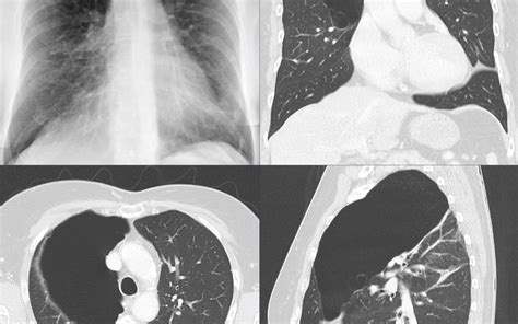 Robust Deep Labeling Of Radiological Emphysema Subtypes Using Squeeze And Excitation