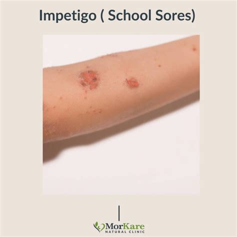 Impetigo School Sores Morkare Natural Clinic