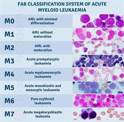 Fab Classification System Of Acute Myeloid Leukemia Haidar Khan