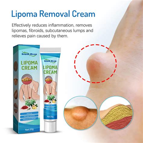 Lipoma Remove Cream Body Care Reduce Lipoma Fat Lumps Subcutaneous Lumps Removal Lazada