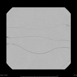 DSA Pelvis Radiology SUNY Upstate