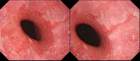 Gerd의 내시경 소견 Endotoday 이준행