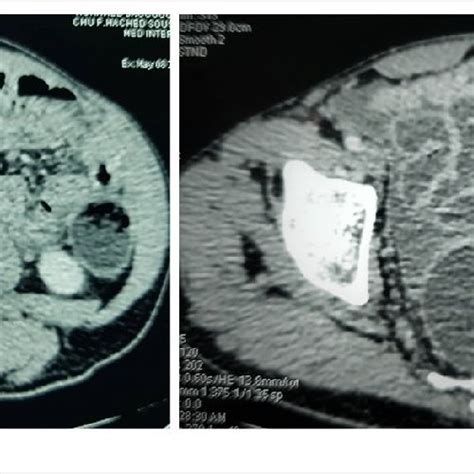 Right Colectomy And Epiploic Mass Resection Download Scientific Diagram
