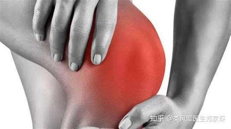 关节炎的症状和危害有哪些？关节炎应该怎么治疗 ？ 知乎