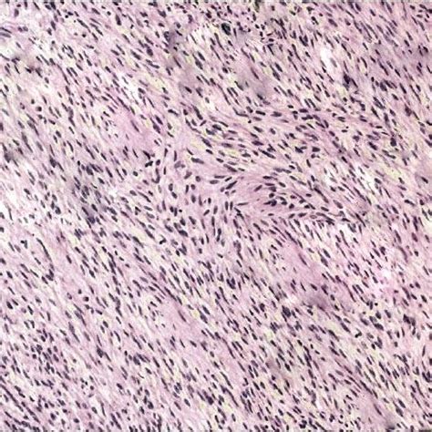 Pdf Symplastic Leiomyoma Of The Uterus Case Report