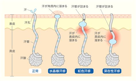 ＜知っておきたい＞大人から赤ちゃんまで発症！あせも（汗疹）の原因・症状・予防法 ロート製薬 商品情報サイト