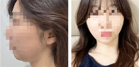 파워v얼굴지방흡입v라인앞볼 민트실리프팅 자갈턱 보톡스 후관리 닥터정리반 닥터정 리반의원