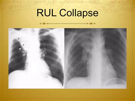 Collapse And Consolidation Made Simple Chest X Rayz Pptx