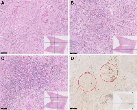 Liver Case Intra Lesional Heterogeneous Distribution Of Download Scientific Diagram