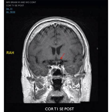 Extensive Patchy Airspace Disease On Ct Scan Of The Chest With Contrast Download Scientific
