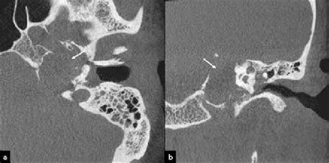 362 A 38 Years Old Male With Recent Vertigo And Recurrent Otorrhea