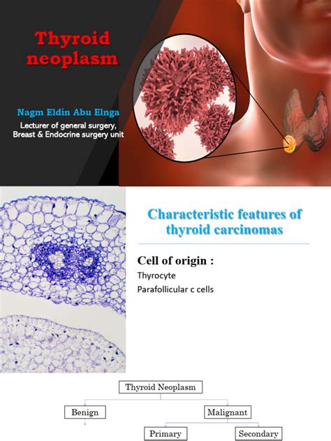 Thyroid Cancer And Post Thyroidectomy Complications Pdf Carcinoma