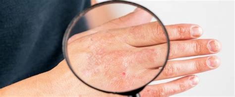 Tanpa Tambahan Madu Begini Cara Atasi Gatal Dan Ruam Akibat Eksim