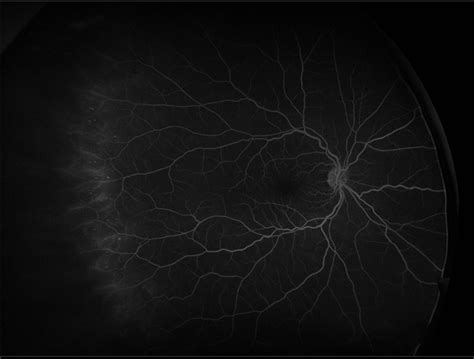Peripheral Retinal Vasculitis Retina Image Bank