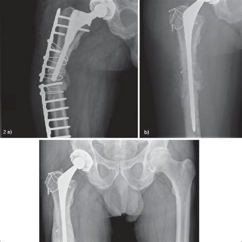 Vancouver Classification System Fracture Classification Vancouver A