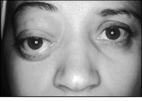 Paciente Con Exoftalmos Secundario A Nfs 1989 Download Scientific Diagram