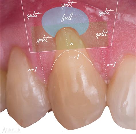 Root Coverage Procedures My First Time 8 Golden Rules On Esthetic
