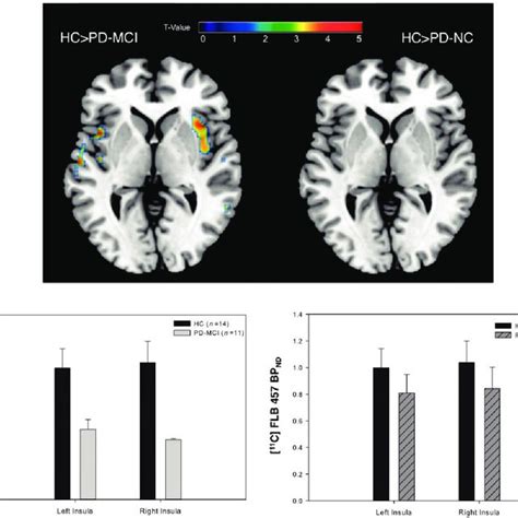 Relationship Between Striatal Dopamine And Insular D2 Levels In