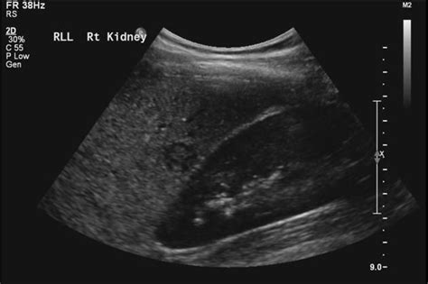 Centrifugal Enhancement In A Liver Lesion Radiology Case