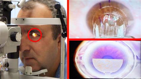 WHAT GETTING LASER EYE SURGERY IS LIKE YouTube