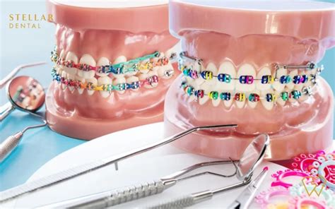 All Braces Colors