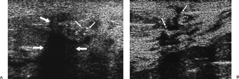 Calcifications Amorphousindistinct Microcalcifications Radiology Key