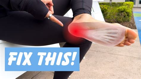 Plantar Fasciitis Everything You Need To Know Youtube
