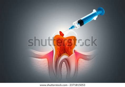 Injection Analgesia Photos And Images And Pictures Shutterstock