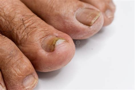 Fungal Nail Infection Onychomycosis Also Called Tinea Unguium Stock