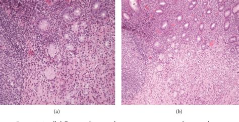 Figure 1 From Diagnosing A Gastric Submucosal Tumor Using Jumbo Biopsy