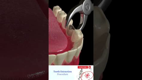 Tooth Extraction Animation Aftercare View Youtube