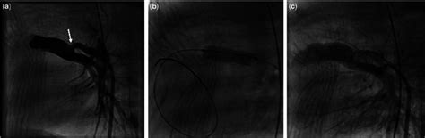 Angiograms Of A Restrictive Pda With Stent Placement A Angiogram