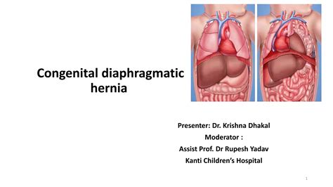 Anesthesia For Congenital Diaphragmatic Hernia Pptx
