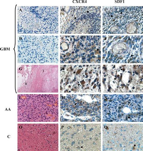 Immunohistochemical Localization Of Cxcr4 And Sdf1 Gbm Ai A And