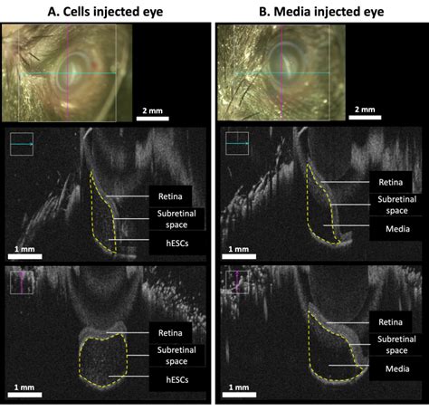 Sub Retinal Delivery Of Human Embryonic Stem Cell Derived Photoreceptor