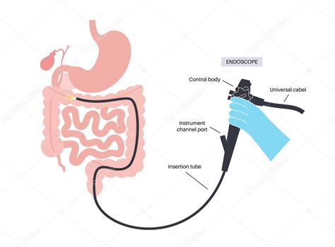 La Colonoscopia Es Un Procedimiento Mínimamente Invasivo Examen Y Tratamiento Del Intestino
