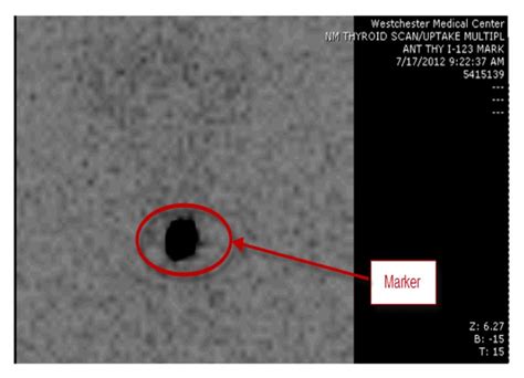 Nilotinib Associated Destructive Thyroiditis Pmc