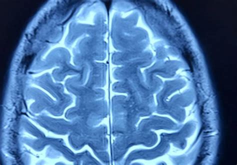 Advanced Mri Scans Help Identify 1 In 3 Concussion Patients With