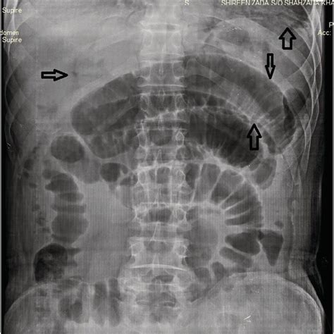Surgical Findings Sigmoid Colon Was Elongated And There Was Scar Near