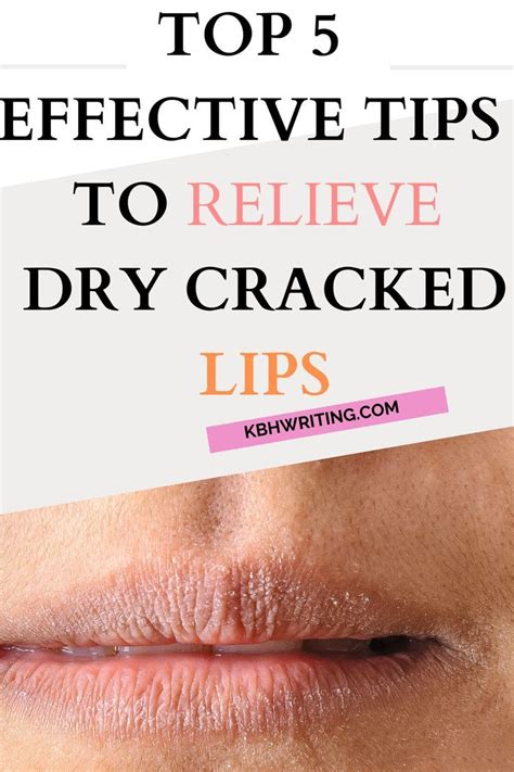 Effective Tips To Relieve Dry Cracked Lips Cracked Lips Dry Cracked