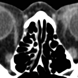 CT Maxillofacial With Contrast Revealed Enhancement Of The Anterior
