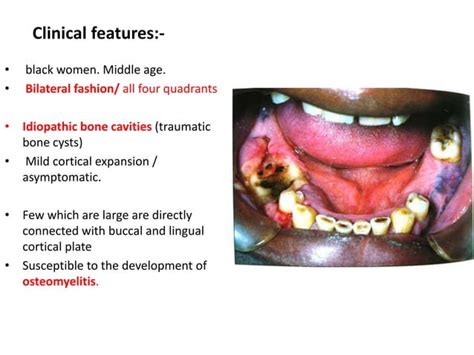 Fibro Osseous Lesions Ppt